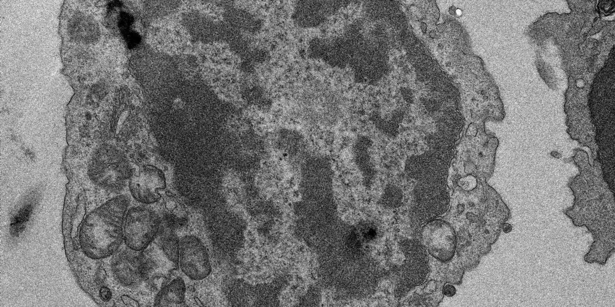 New marker for better assessing the severity of Covid-19 - LMU Munich